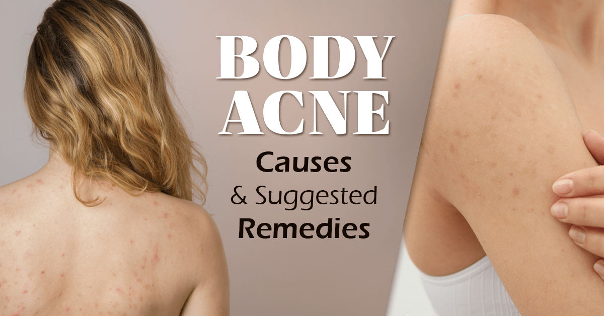 Know Ayurvedic Approach To Body Acne And Herbal Remedies